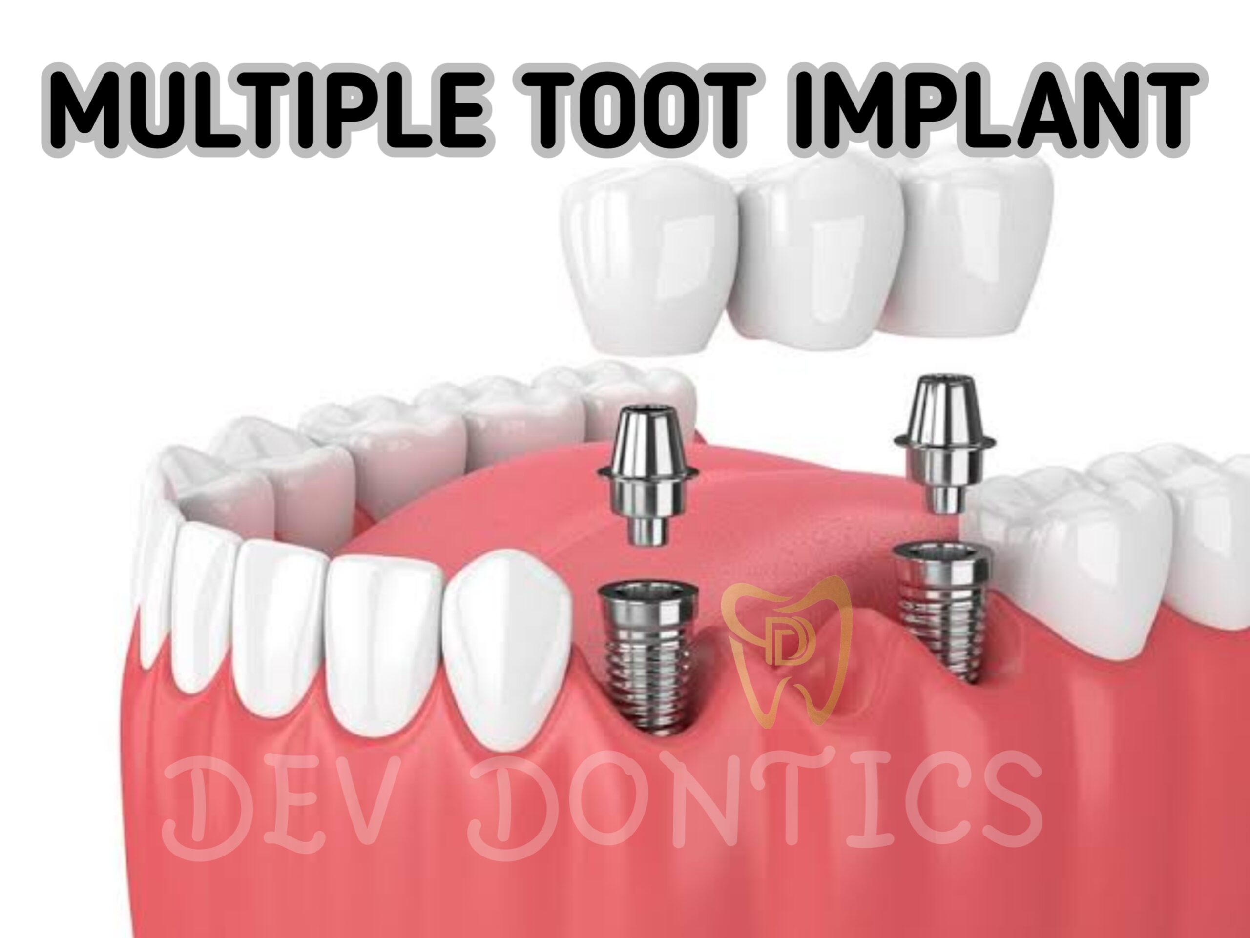 DENTAL IMPLANT FOR MULTIPLE MISSING TEETH - DEV DONTICS