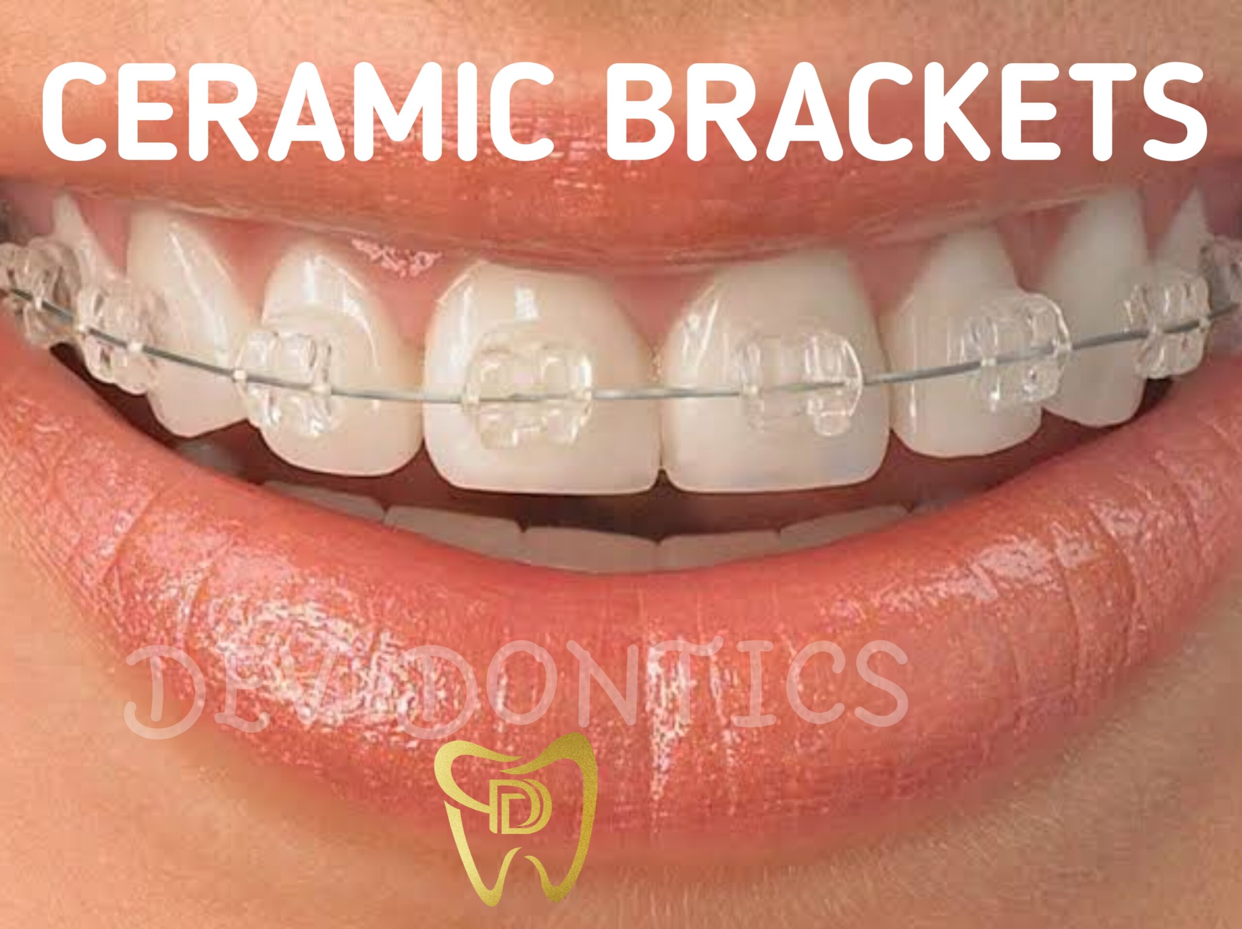 CERAMIC BRACKETS - DEV DONTICS