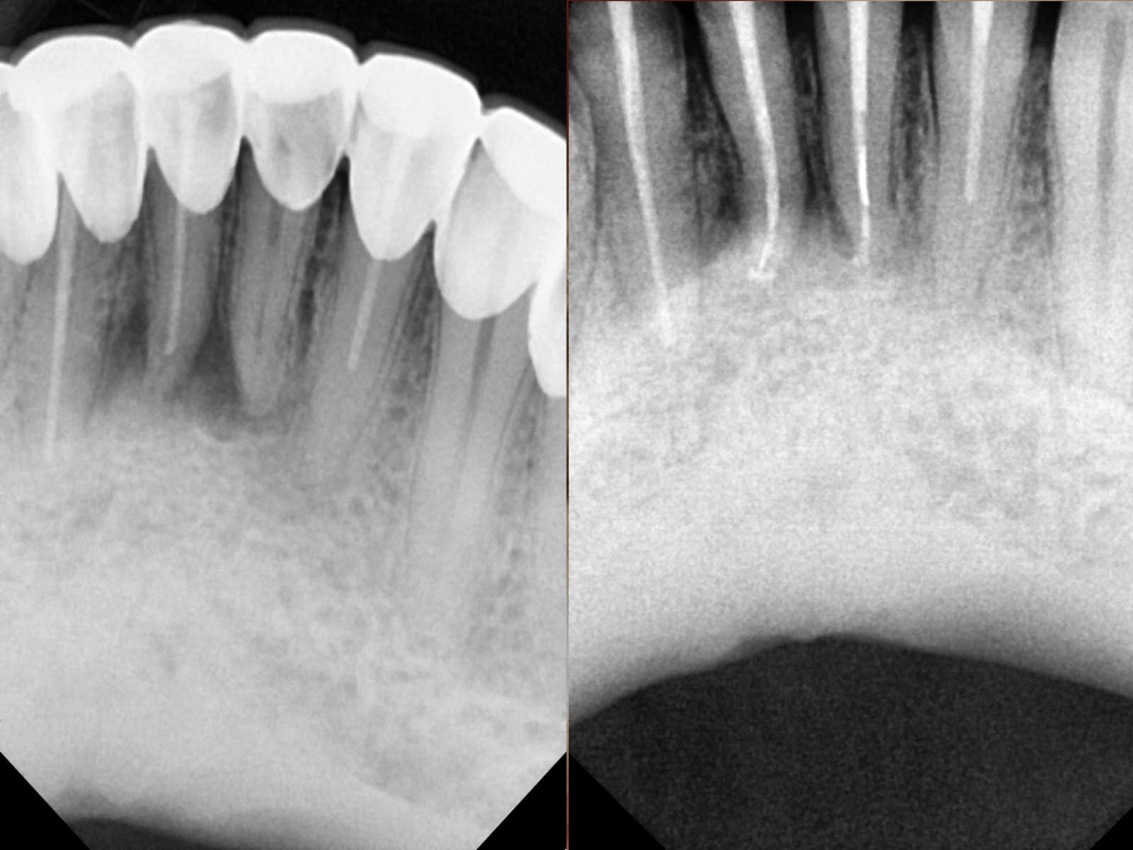 RE ROOT CANAL TREATMENT: A Comprehensive Guide - DEV DONTICS